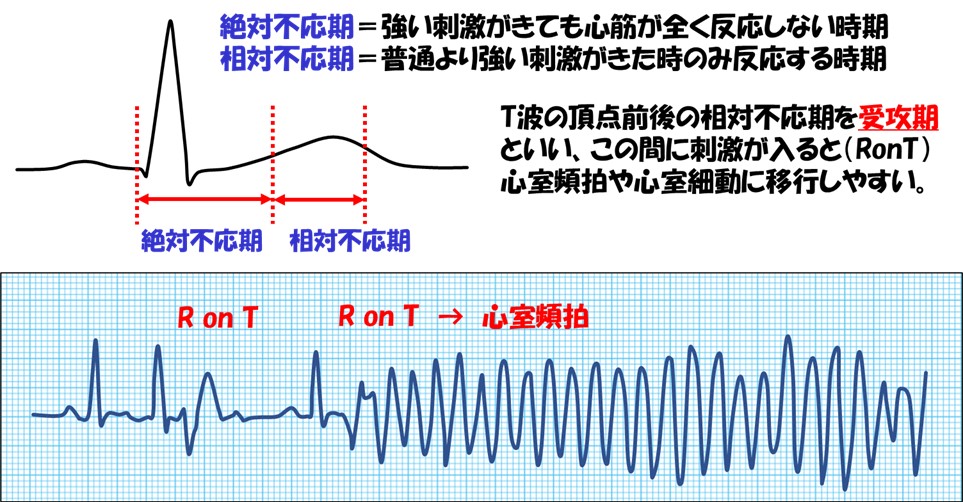 期外収縮 - 心電図/電気生理/アブレーション講座